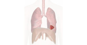 The Lingula and Lung Parenchyma: Lesser-Known Structures